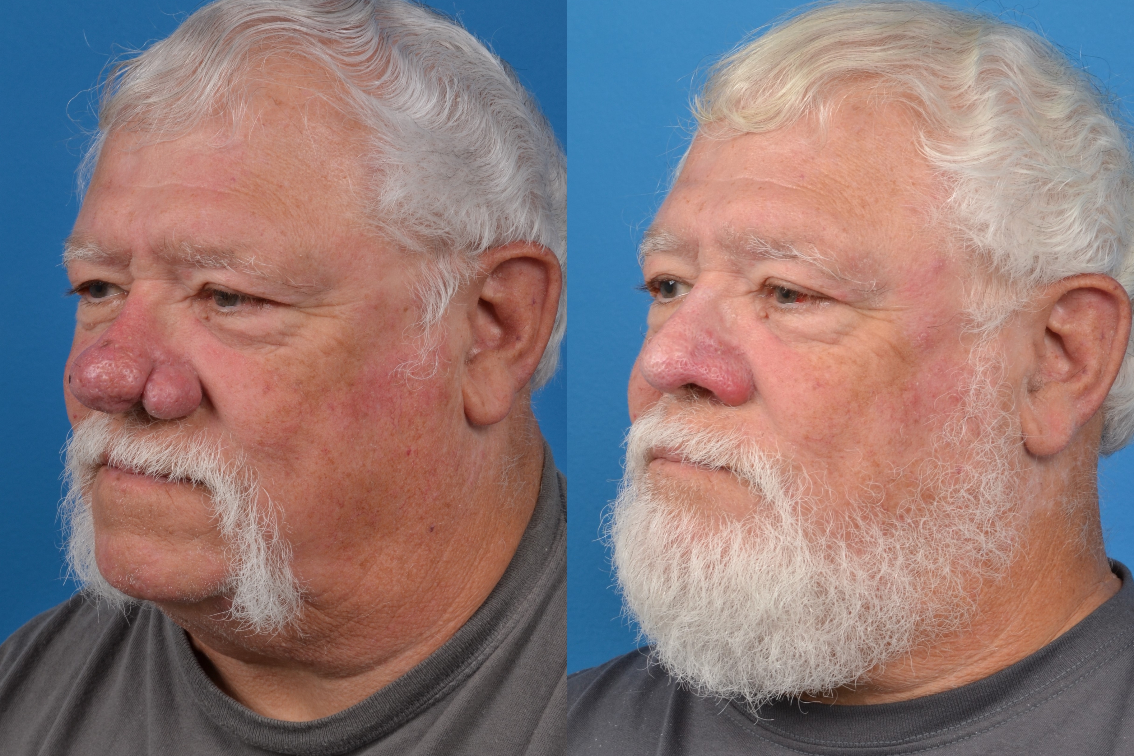 Rhinophyma Melbourne Fl Patient 29296